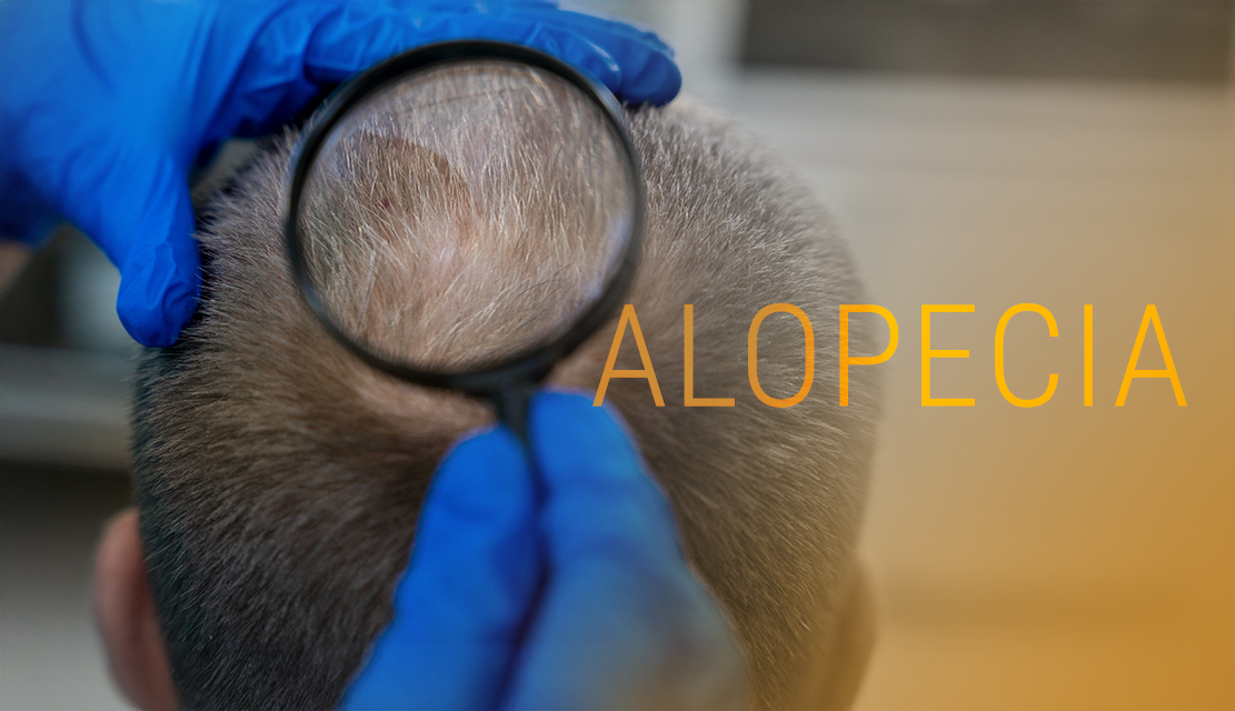 Alopecia: Comprendiendo Tratamientos Efectivos